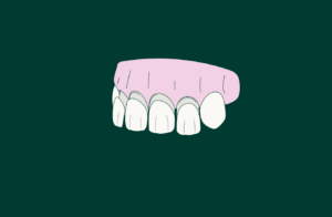 Veneer Prep Guide: Tooth Preparation for Veneers | Dandy