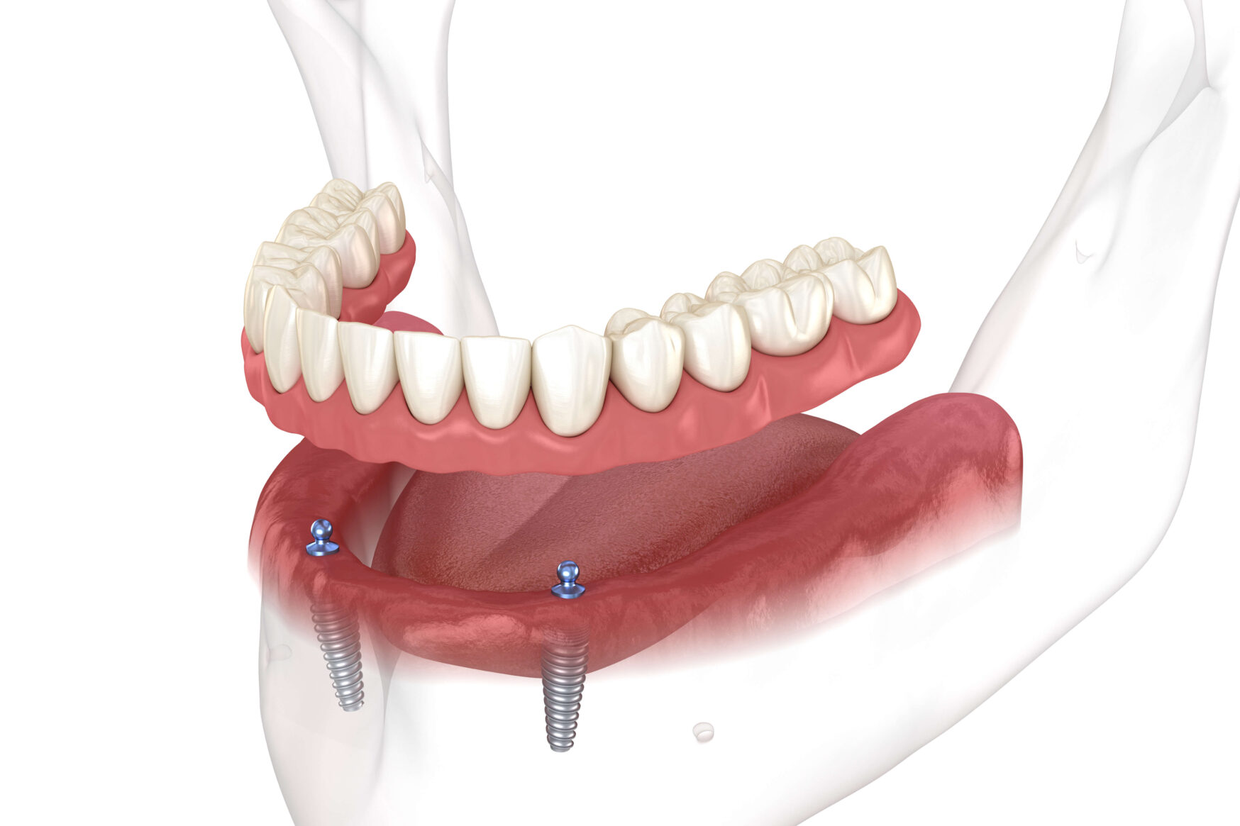 Implant Overdenture Steps and Clinical Protocol | Dandy