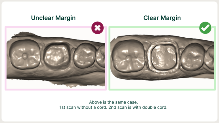 Why we love the double cord retraction technique - Dandy