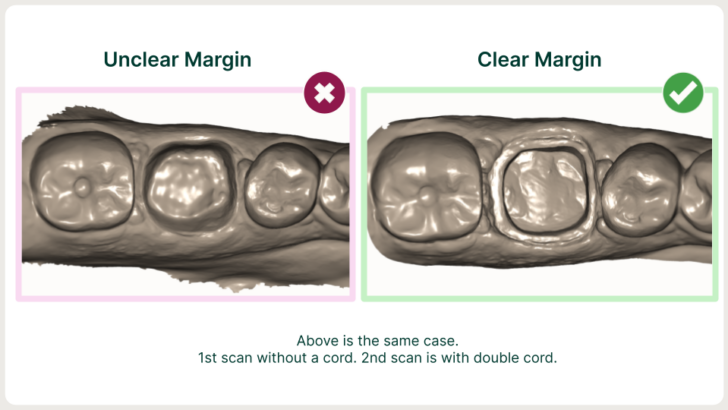 Why we love the double cord retraction technique - Dandy
