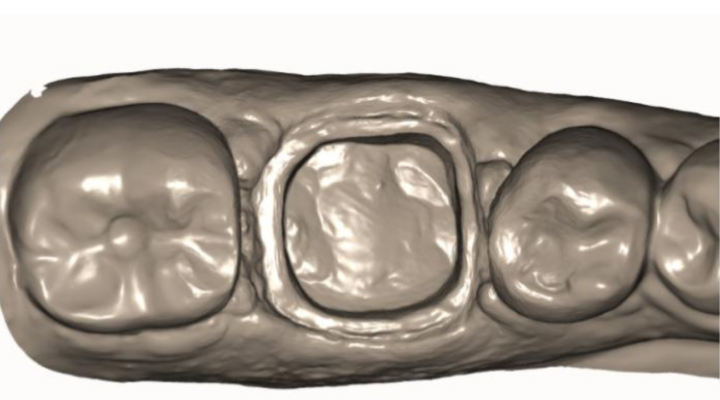 The best gingival retraction techniques [for digital dentistry]
