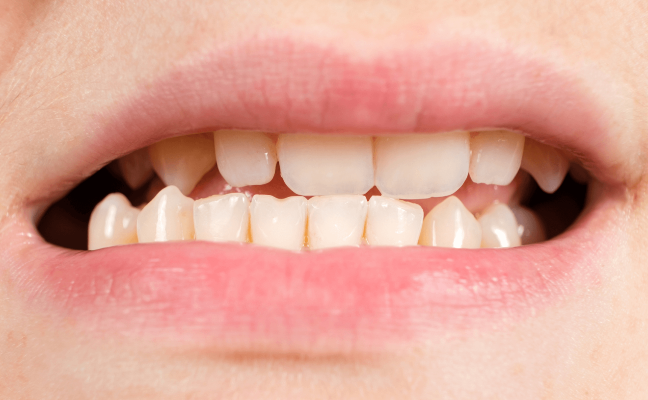 Vertical Dimension of Occlusion (VDO) | Dandy