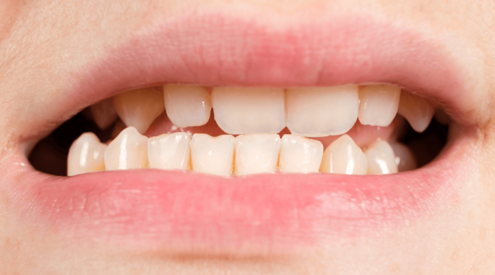 Reduction Copings 101: Worth it? | Dandy