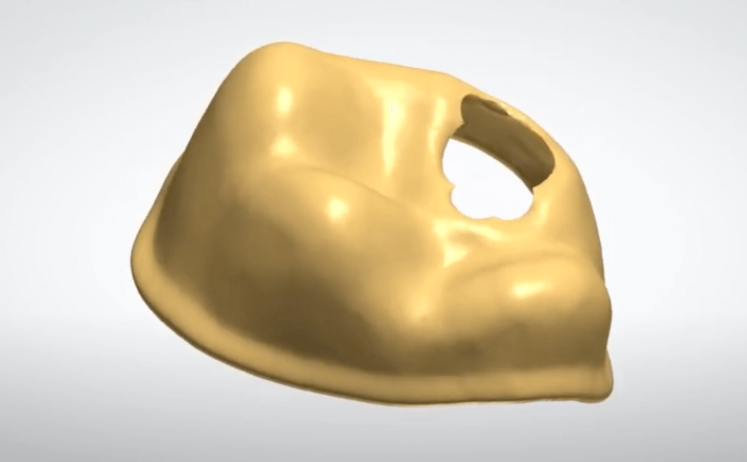 Reduction Copings 101: Worth it? | Dandy