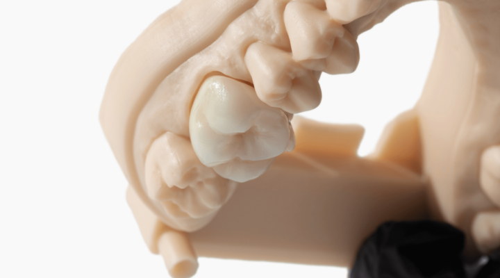 Reduction Copings 101: Worth it? | Dandy