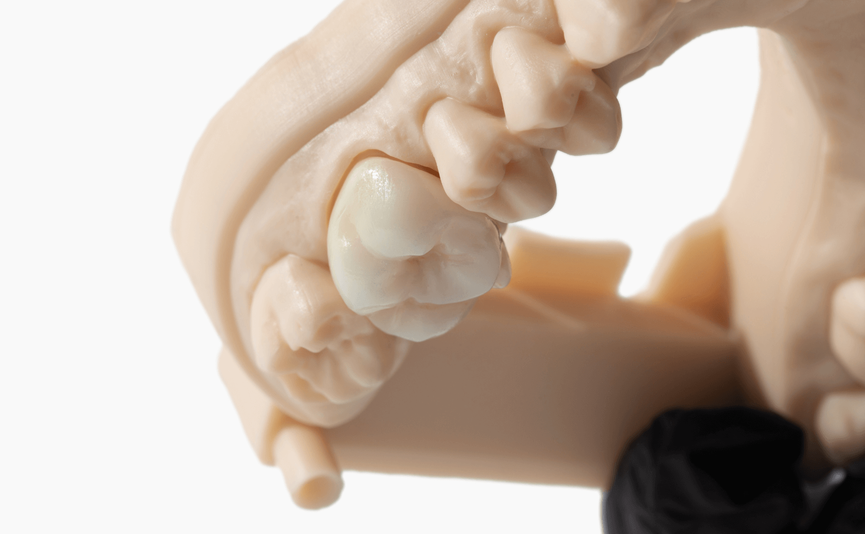 10 tips for perfect fitting dental crowns - Dandy