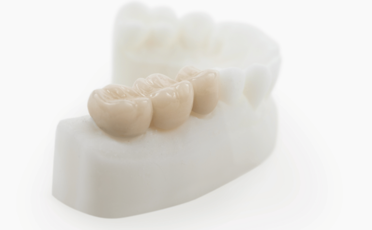 PFM Crown Prep: Tips when using digital dentistry | Dandy