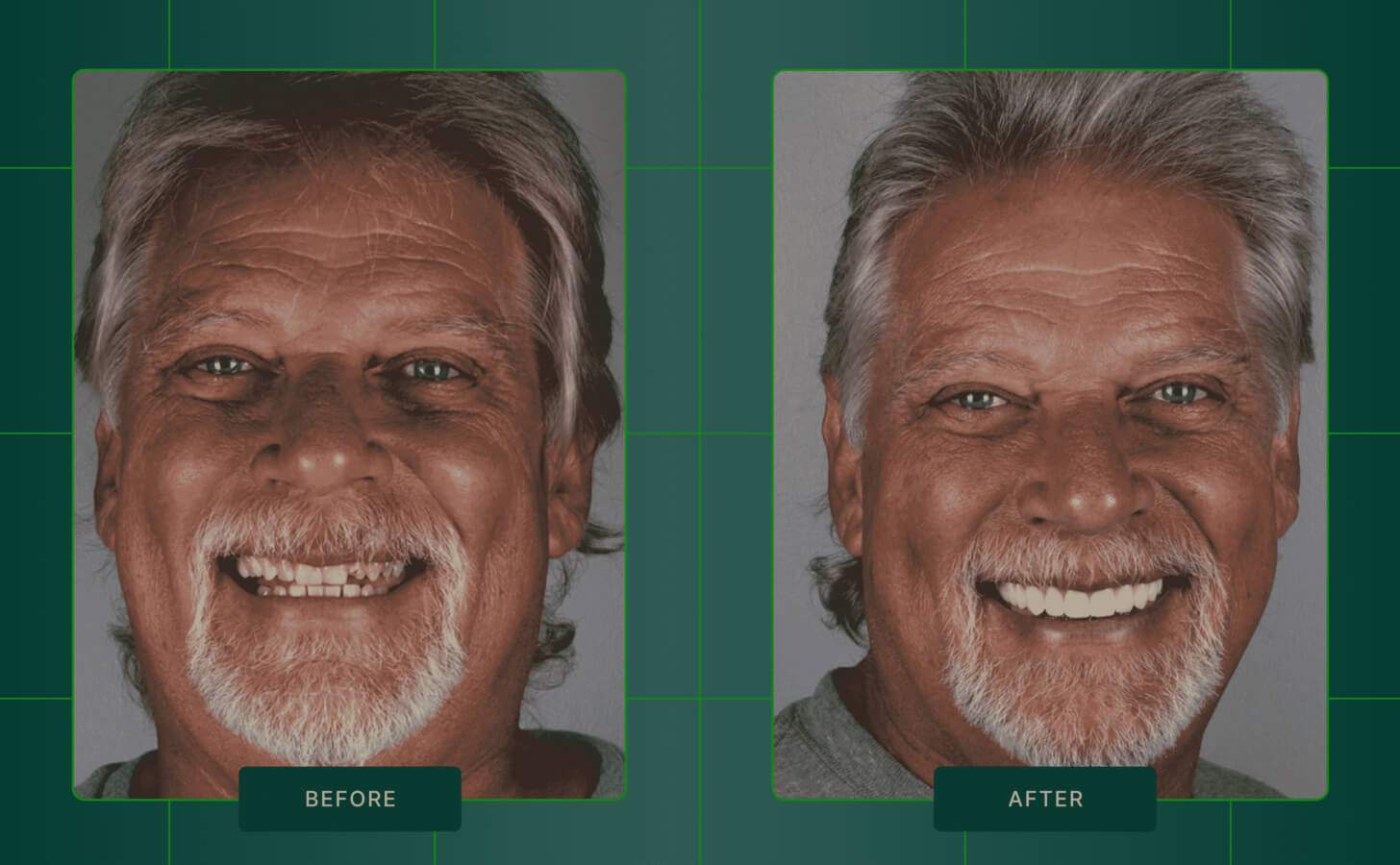 Case Study: 10-Unit Zirconia Smile Transformation - Dandy