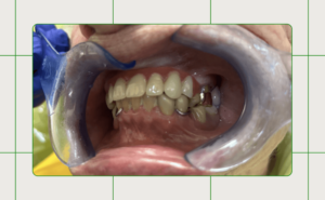 Restoring the anterior zone with maxillary partials | Dandy Labs