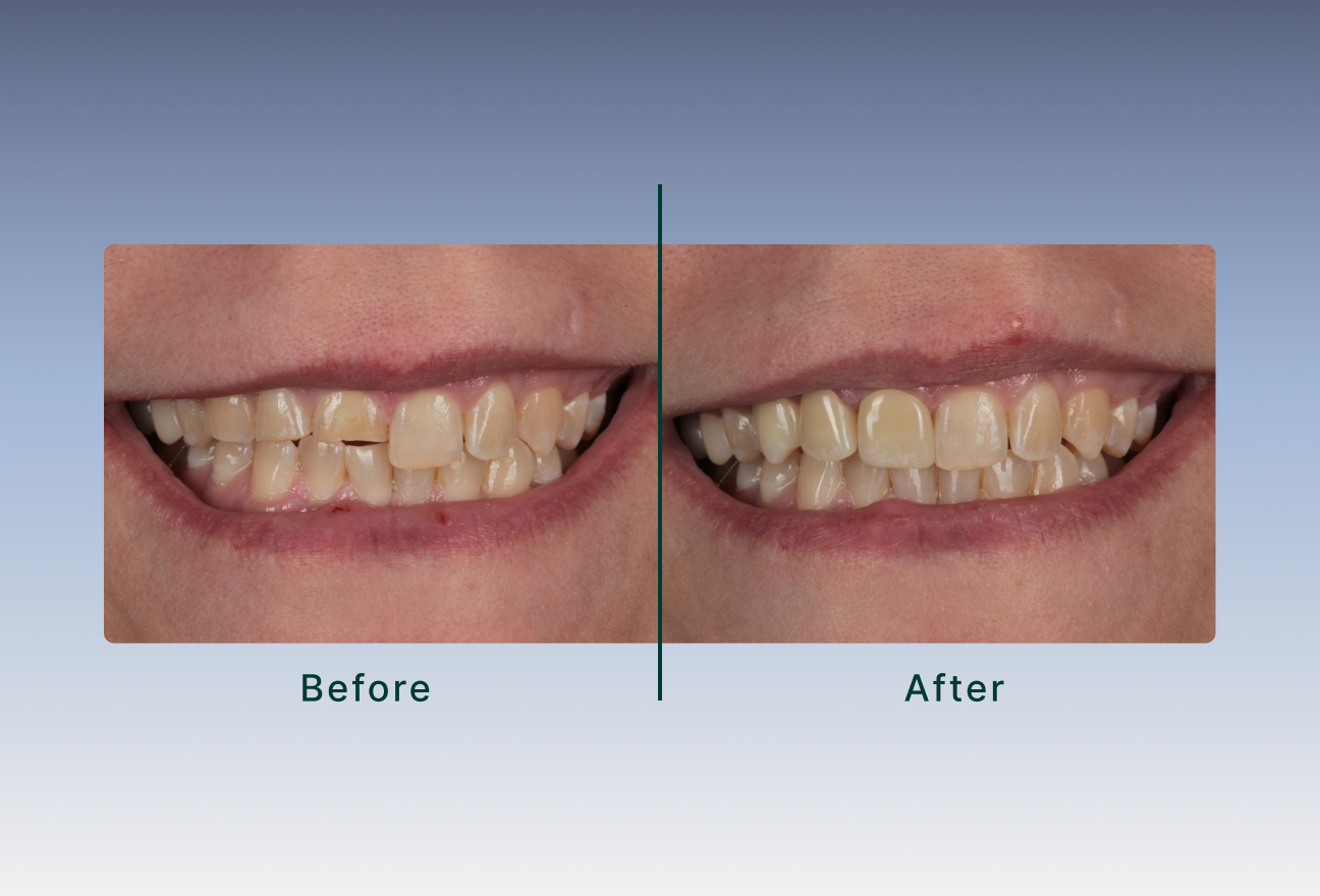 Case Study: Restoring Anterior Aesthetics After Trauma - Dandy